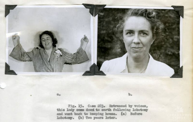 Do You Need a Lobotomy? Just Look at the Results From These Before and ...