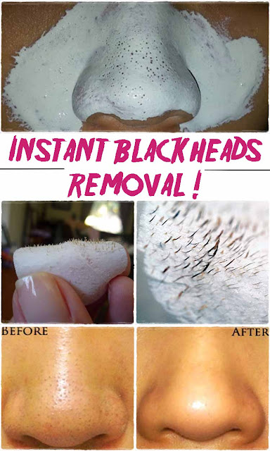 Say goodbye blackheads in 15 minutes ! | Top Health Remedies