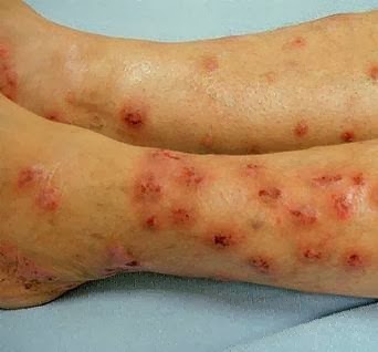 Dermatología 007: Prurigo (Grupo 2)