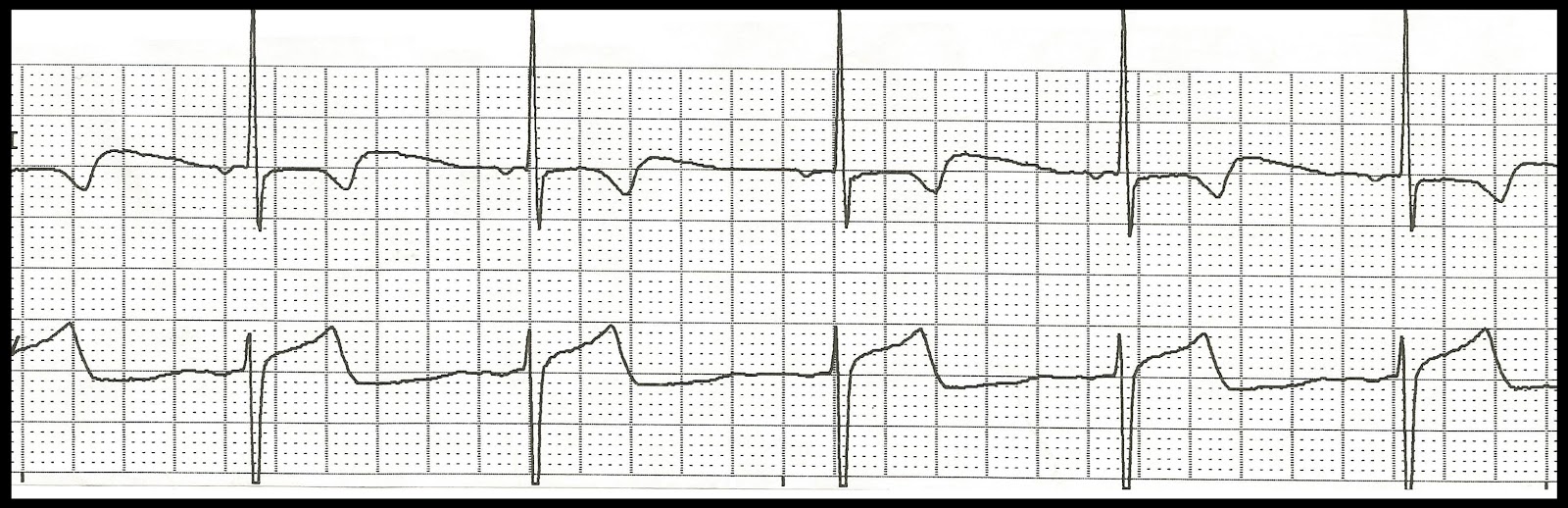 EKG Rhythm Strip Quiz 98: Junctional rhythms