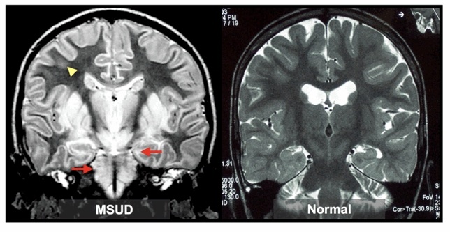 Jake's Honors Biology Blog: Maple Syrup Urine Disease (MSUD)