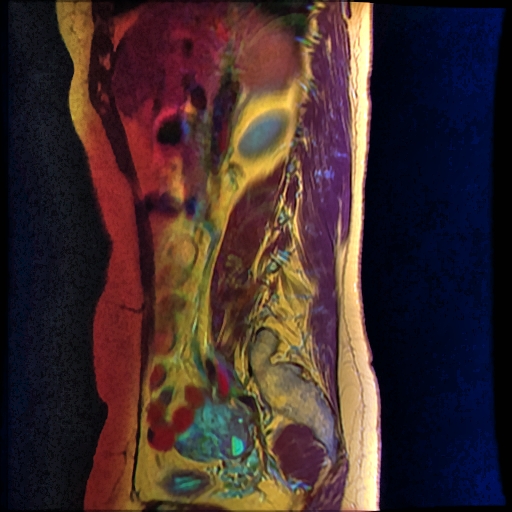 Nevit's blog: Color MRI of the Lumbar spine with extruded disc