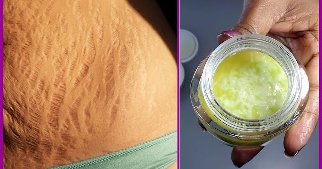 INILAH CARA MUDAH DAN CEPAT UNTUK MENGHILANGKAN STRETCH MARKS DI LENGAN ...