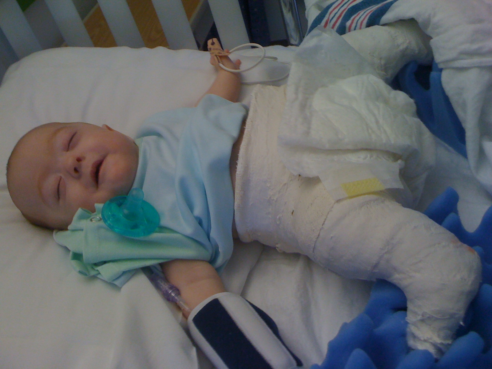 My Baby with Bilateral Club Feet: Life with Club Feet & Hip Dysplasia