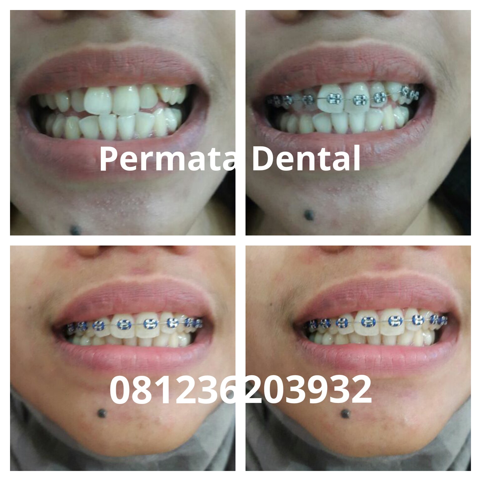 DOKTER GIGI BALI: Pasang Behel Untuk Tujuan Merapikan Gigi Di Permata ...