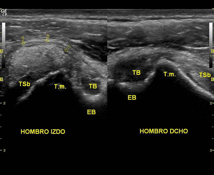 Reumails. Reumatología al día: Imágenes en Reumatología - Lesión ...