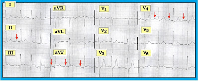 ECG Interpretation: ECG Interpretation Review #43 (AFib - PACs - Acute ...