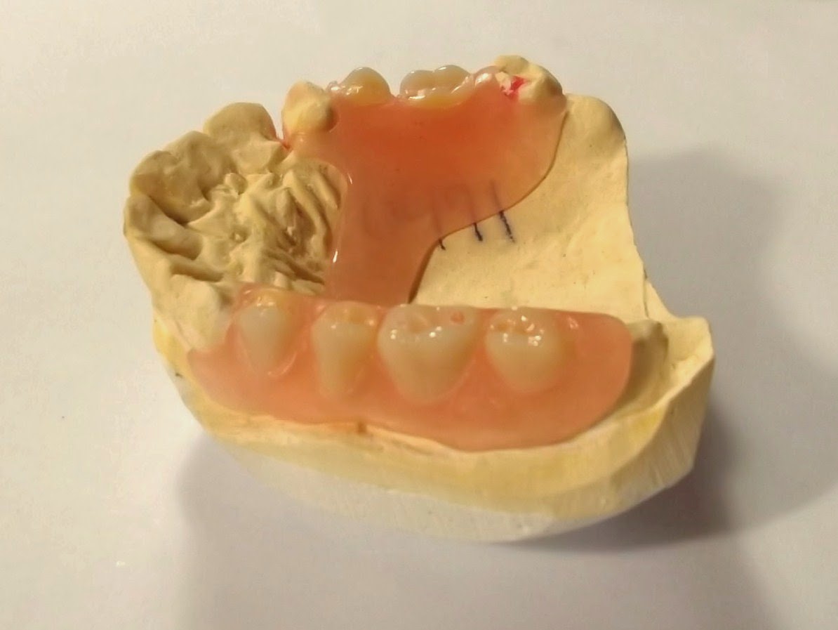 Laboratorio Flexys: Próteses Flexíveis em Poliamida