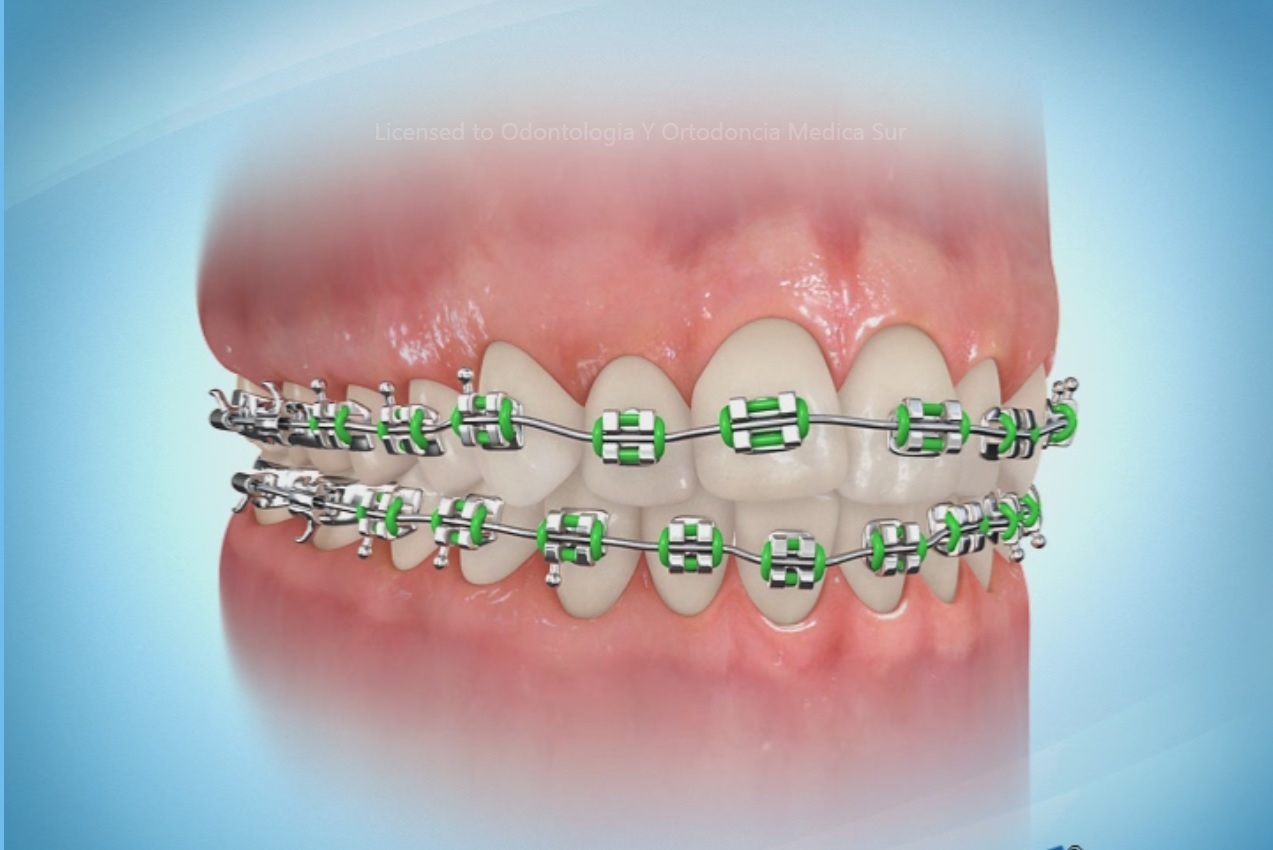 ORTOGRANADOS: Tipos de Brackets