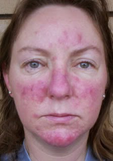 Scarlet Letters, dealing with vascular rosacea, face flushing, burning ...