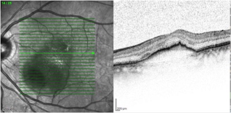 Centro de Oftalmología Abreu: DEGENERACIÓN MACULAR ASOCIADA A LA EDAD ...