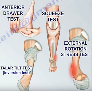 Dr. Nabil Ebraheim's Blogspot: Ankle Ligaments Injury, Tests & Assessment