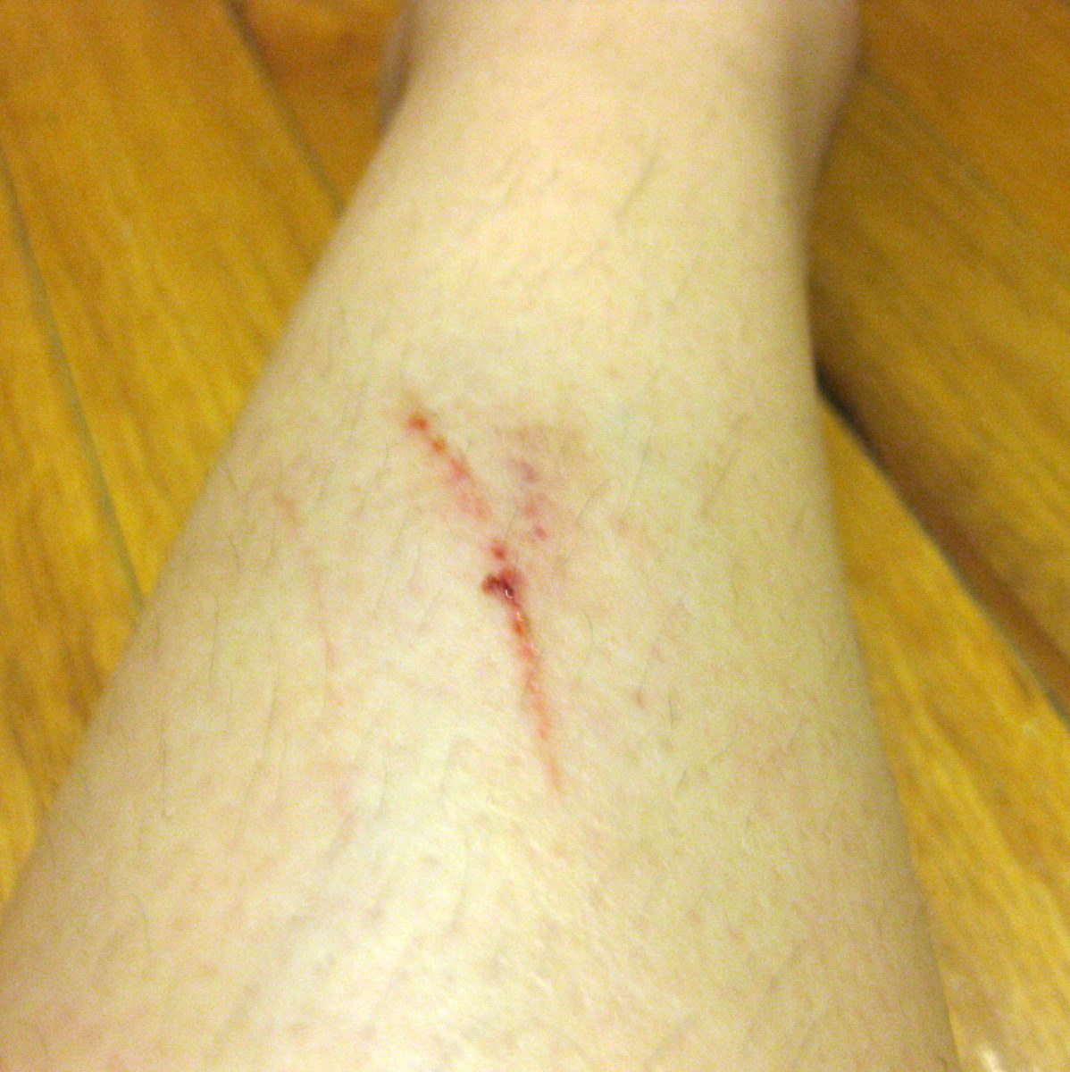 Urban Herbal Girl: What to do with a bruise and a cut- first aid part II