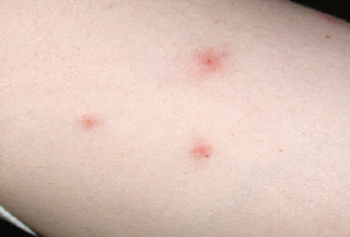 Piqûres de puces sur les humains - Photos, traitement et prévention