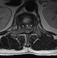 Dr Balaji Anvekar FRCR: Compression fracture with cord contusion