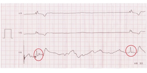 ECG Rhythms: Extreme supraventricular bradycardia