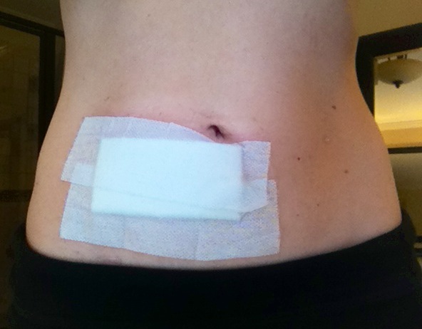 My UC Story: Healing Scars: 6 Weeks Post Reversal Surgery