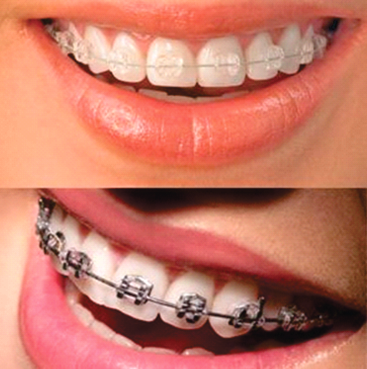 O Jornalecão: Aparelho Ortodôntico Estético