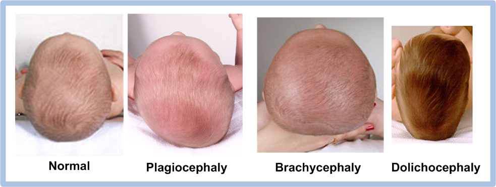 Baby Flat Head Syndrome and prevention from Pediatric Nurse Perspective