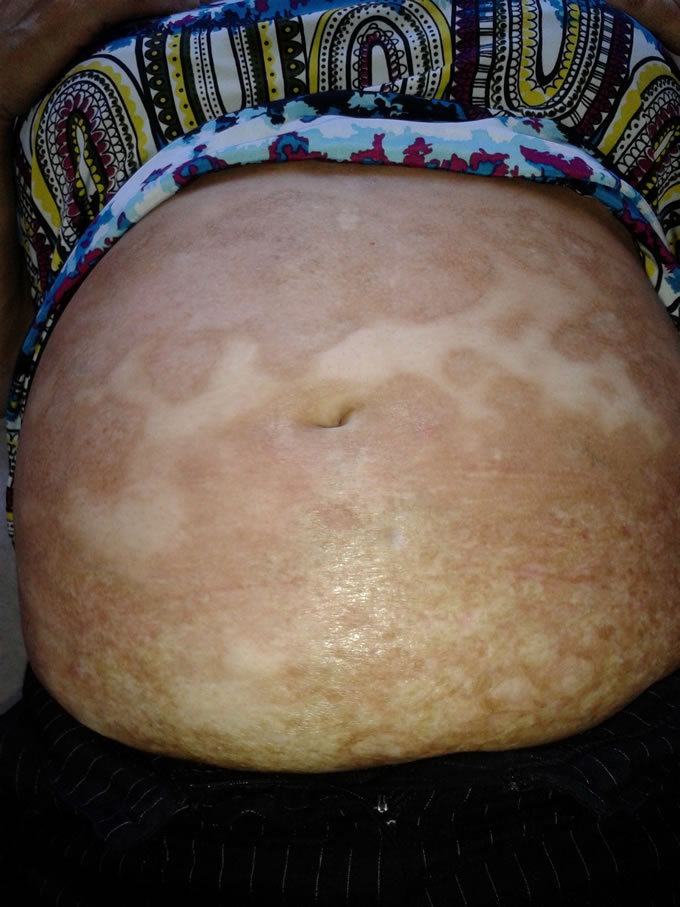 O que é Morféia ou esclerodermia? - Geri e Derme Beauty