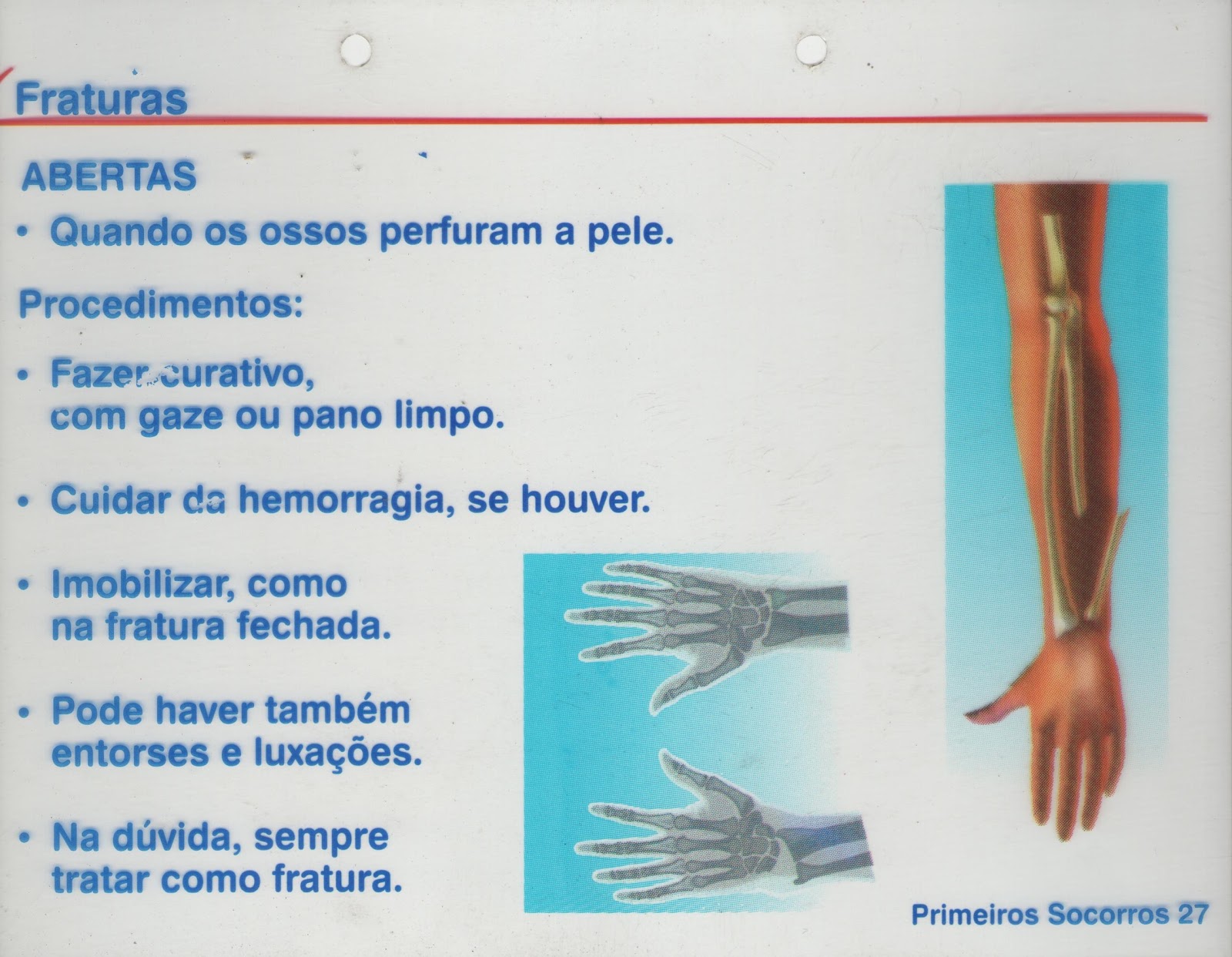 Em Caso De Fratura Fechada O Socorrista Deve - RETOEDU
