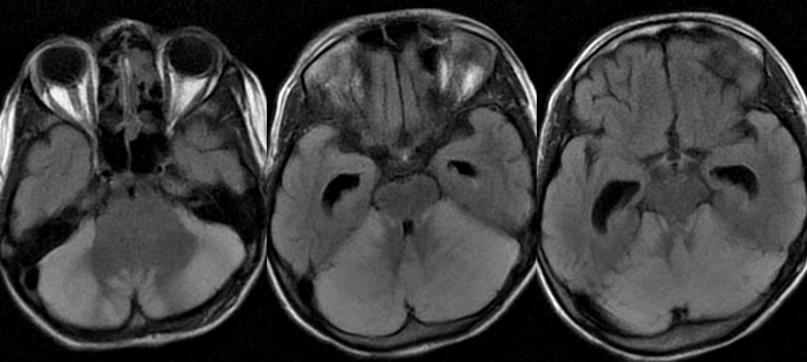 Dr Balaji Anvekar FRCR: Acute cerebellitis MRI