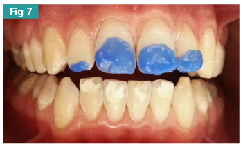 Molar Incisor Hypomineralization (MIH): Conservative Treatment Approach