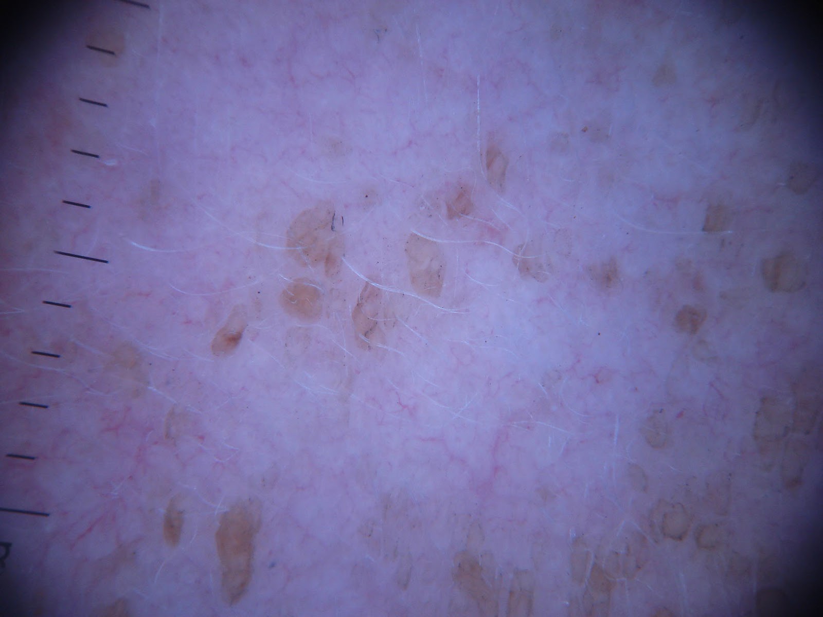 VIRTUAL GRAND ROUNDS IN DERMATOLOGY 2.0: Dermatitis Neglecta