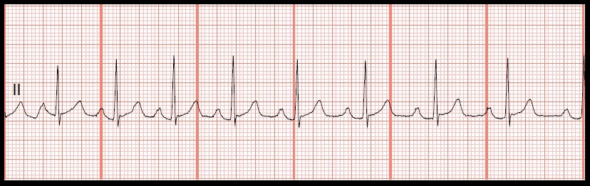 Practice EKG Rhythm Strips 145