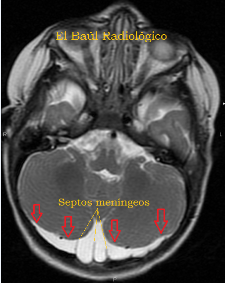 El Baúl Radiológico: ASPECTO DE LA CISTERNA MAGNA EN TOMOGRAFÍA ...