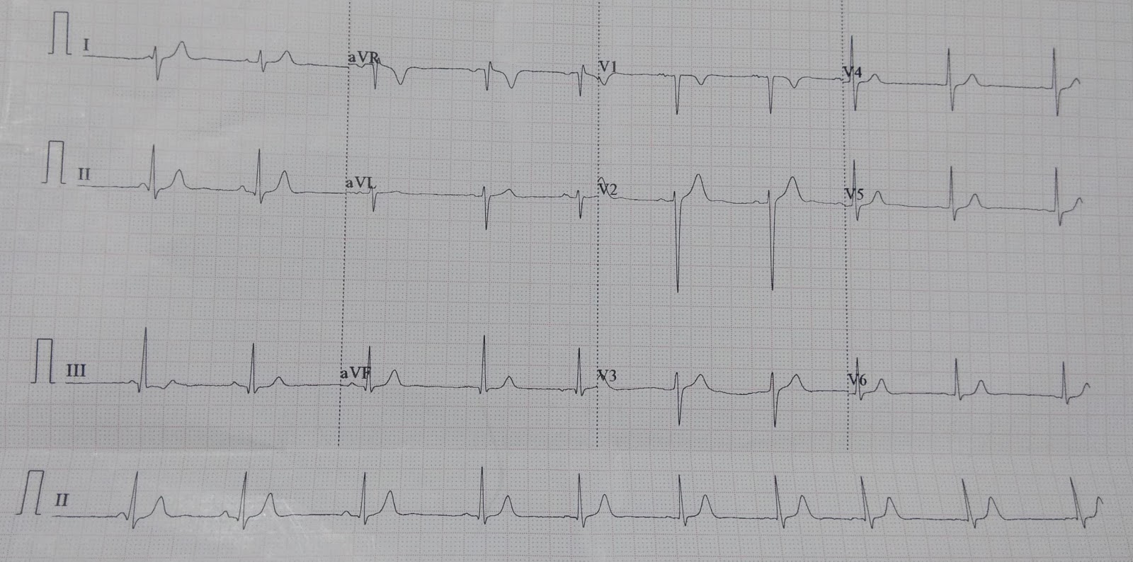 Cardiology window: Left anterior fascicular ventricular tachycardia