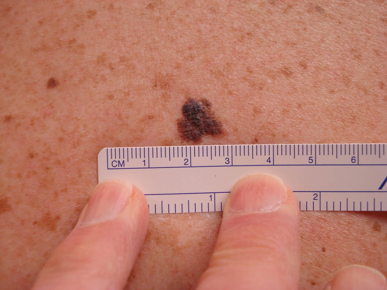 VIRTUAL GRAND ROUNDS IN DERMATOLOGY 2.0: New Pigmented Lesion