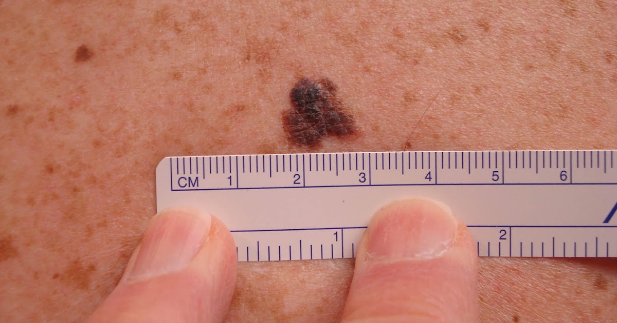 VIRTUAL GRAND ROUNDS IN DERMATOLOGY 2.0: New Pigmented Lesion