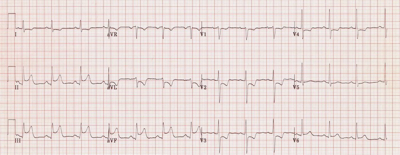 Inferior ST Elevation Myocardial Infarction | INA - ECG