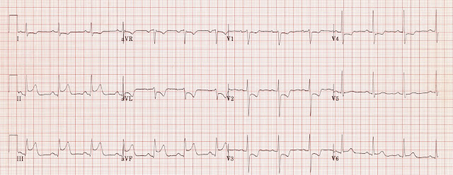 Inferior ST Elevation Myocardial Infarction | INA - ECG