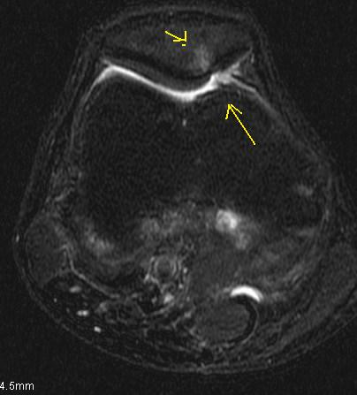 Articular cartilage Defect- MRI - Radiology Imaging
