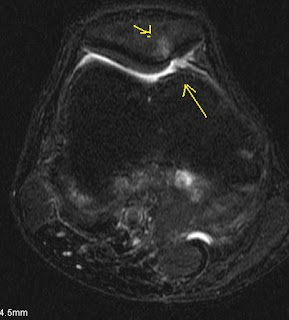 Articular cartilage Defect- MRI - Sumer's Radiology Blog