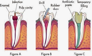 Pitched roof insulation: How to fix a cavity