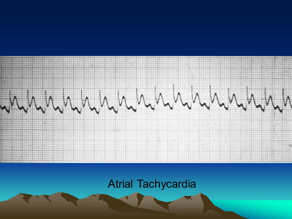 CVT Mohd Farid: Electrocardiogram ECG Part III Basic ECG Rhythm Pattern ...