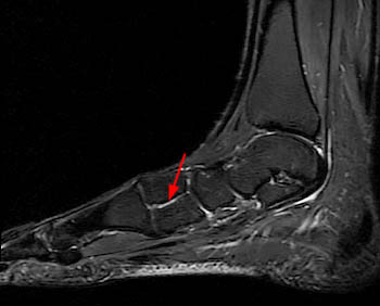 MRI Musculo-Skeletal Section: Bipartite medial cuneiform.
