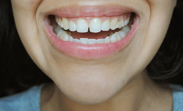 My Life with Invisalign