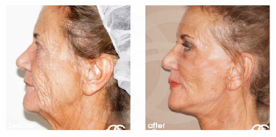 Plastic and Cosmetic Surgery: Get Rid of Your Turkey Neck Before Christmas!