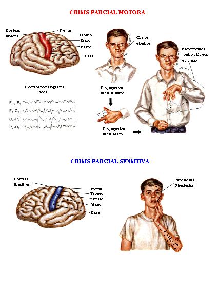 Epilepsias Parciales; Epilepsia Focal; Epilepsia Parcial Simple ...