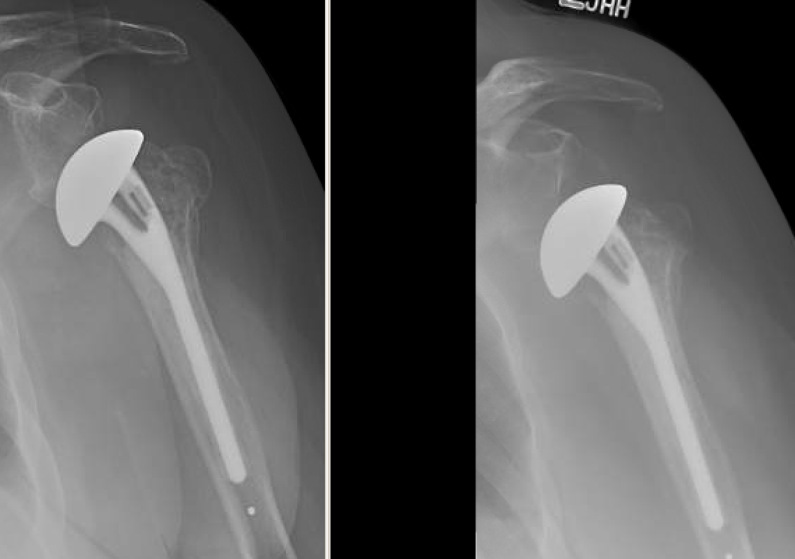 Shoulder and Elbow Surgery: Proximal humerus fracture dislocation with ...