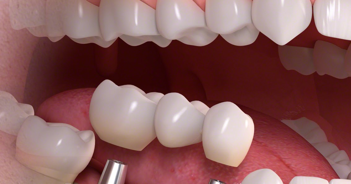 International Dental Implant Center: Multiple Tooth Replacement ...