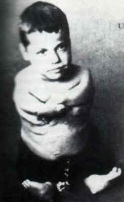 Retales de Historia: La talidomida