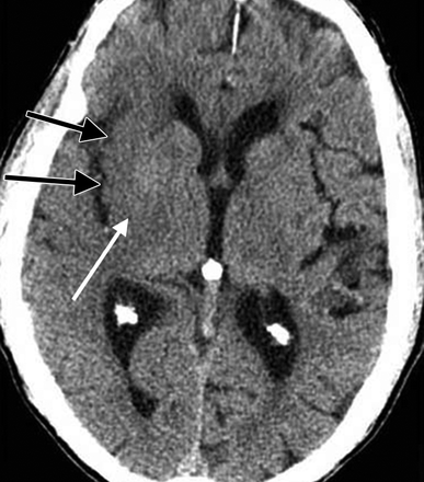 X-RAYview: Sinais precoces de AVC ISQUÉMICO em Tomografia