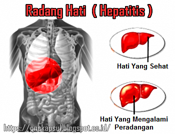 Kenali Ciri-ciri Orang Terkena Penyakit Radang Hati ~ Berbagi informasi ...