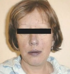 Facie icterica .- Color amarillo en cara y conjuntiva, por acumulación ...