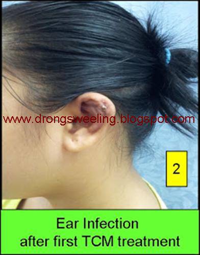 TCM News: TCM healed Man with a Boil, Abcess